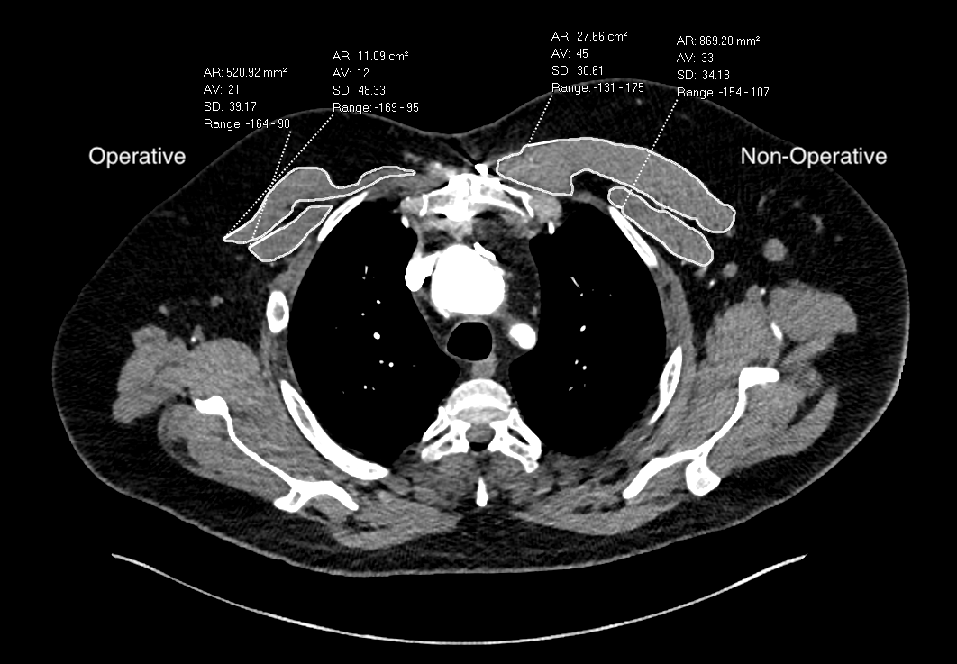 20.06 Axillary Artery Cannulation is Associated with Pectoralis Muscle ...