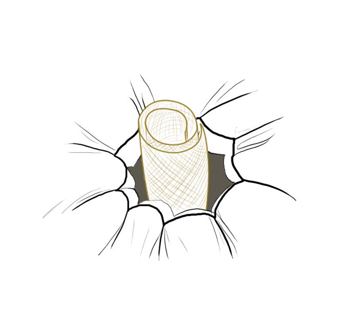 81.02 Infectious Complications After Modified Stomal Purse-string ...