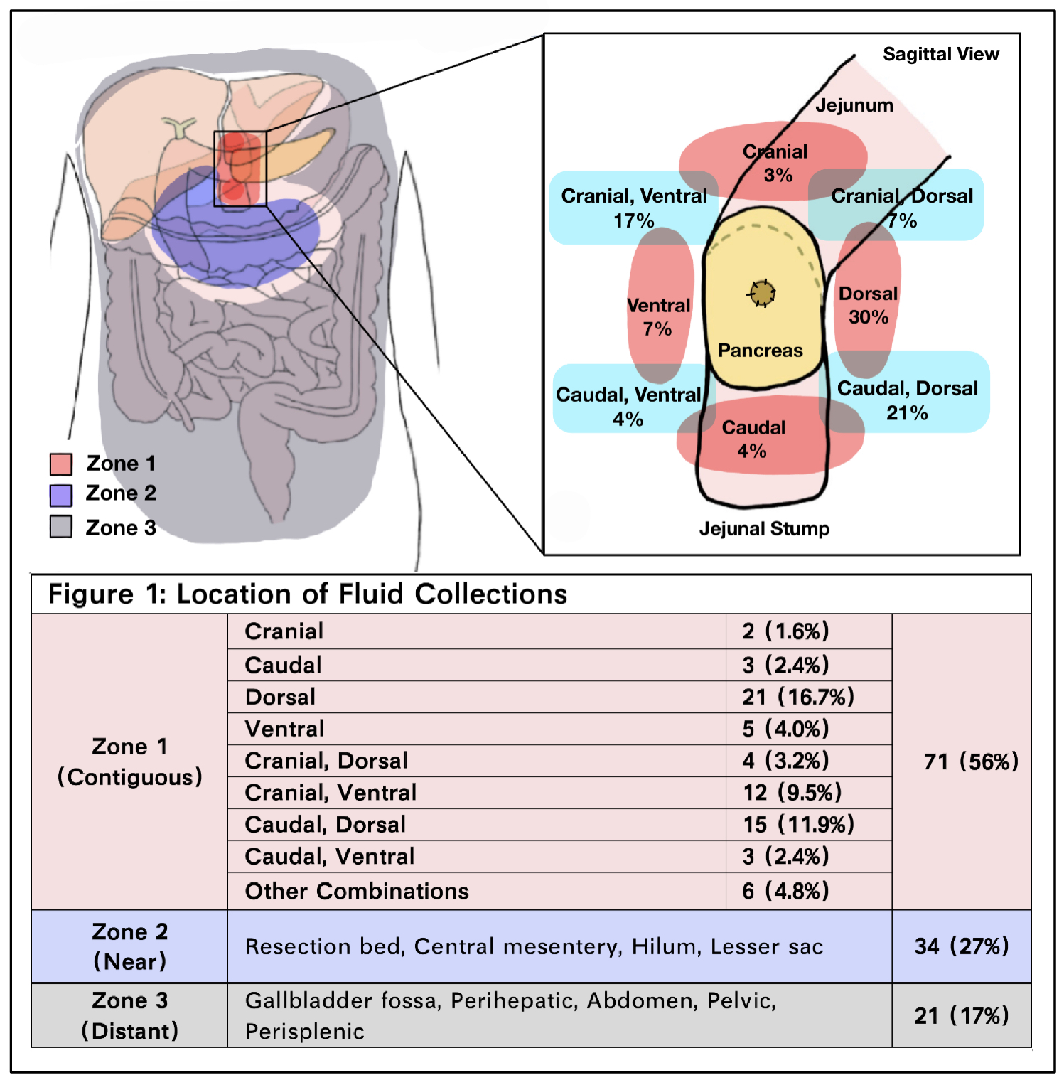 103.02 Pancreaticoduodenetomy Fluid Collections: Proposal for Reporting ...